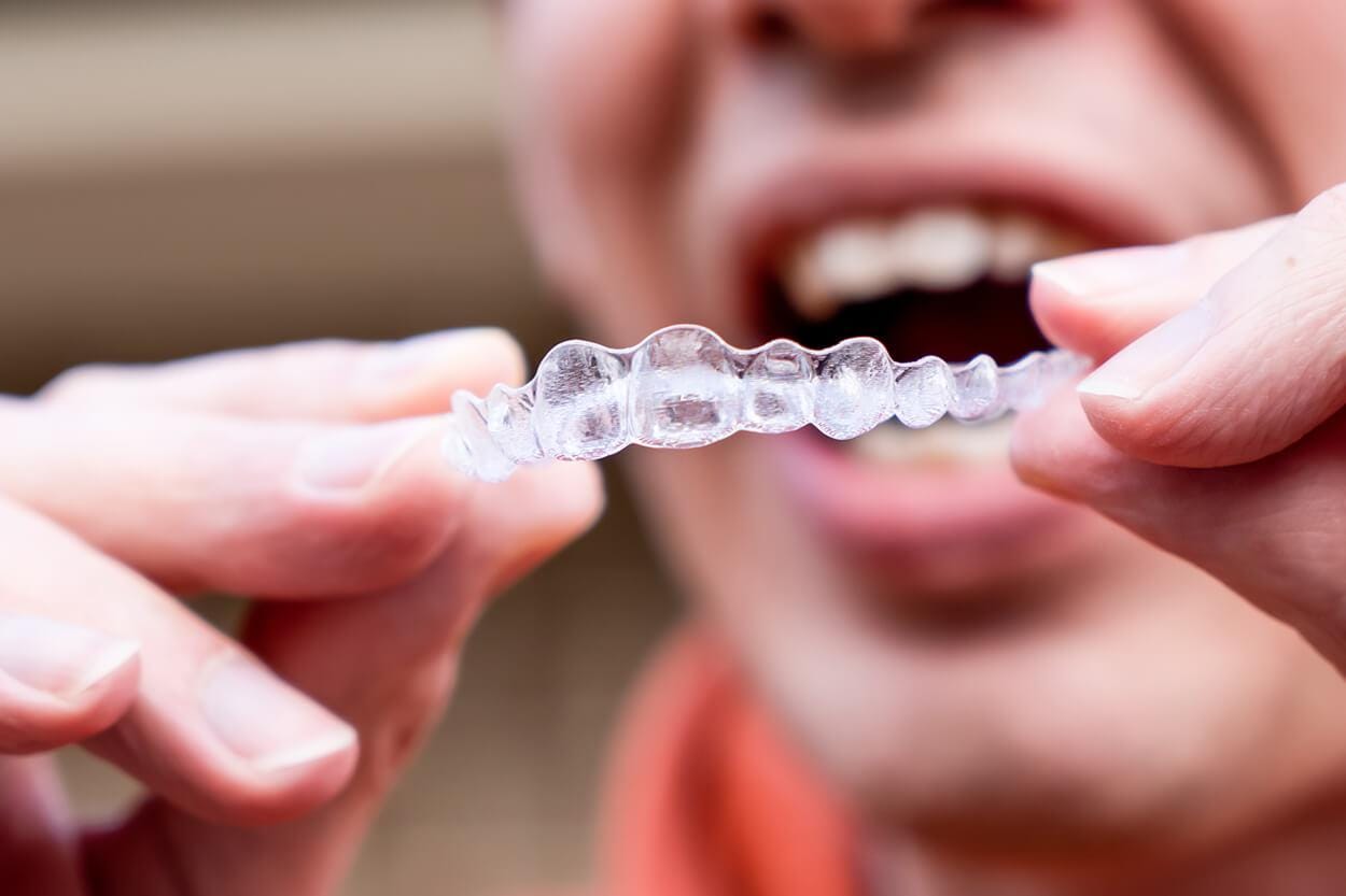Orthodontic Treatment with MK Aligners: How It Works and Its Advantages ...